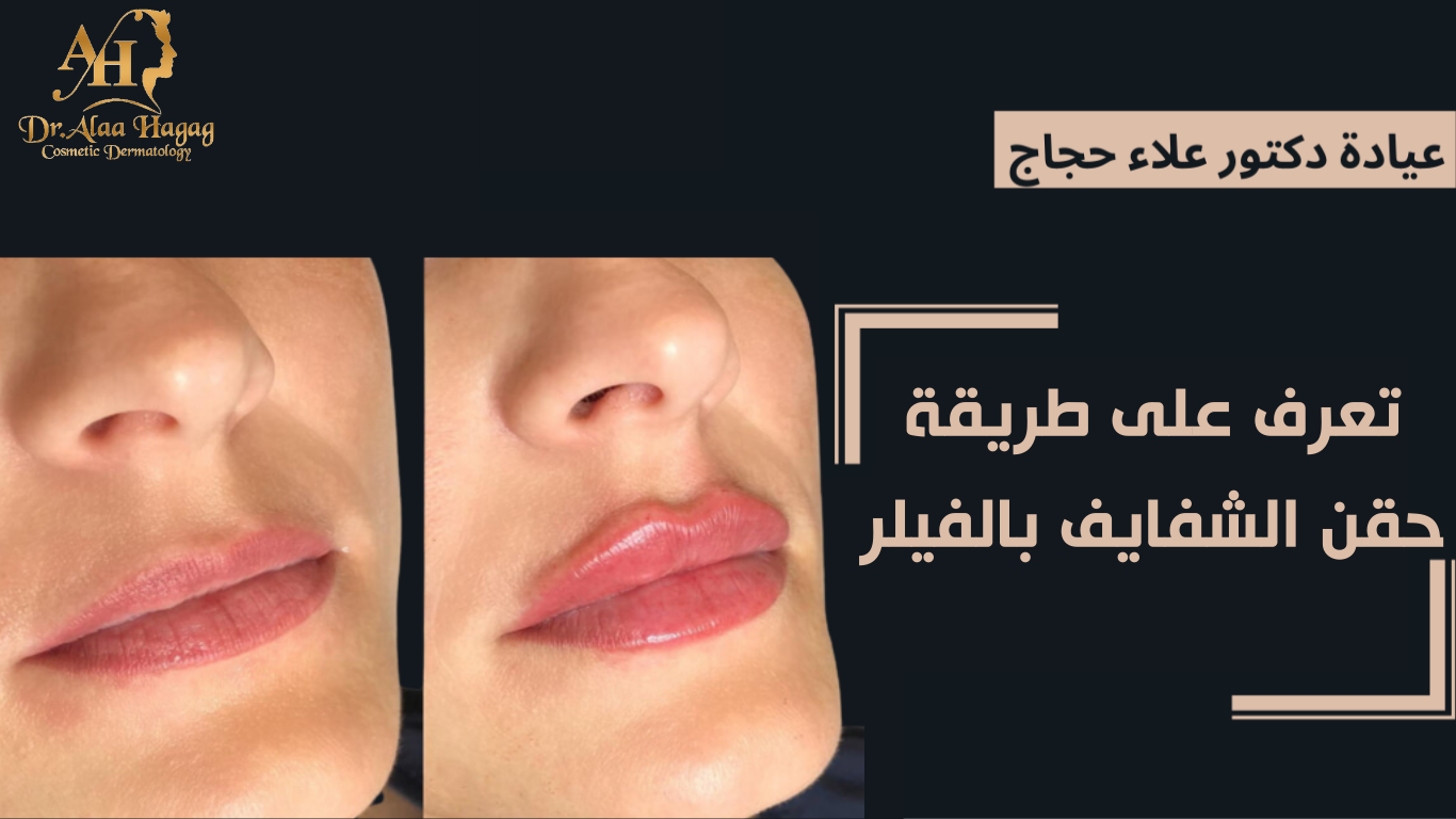 طريقة حقن الشفايف بالفيلر في 10 خطوات لا تفوتك |dralaaclinic